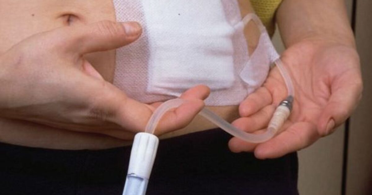 Peritoneal dialysis | Kidney Health Australia